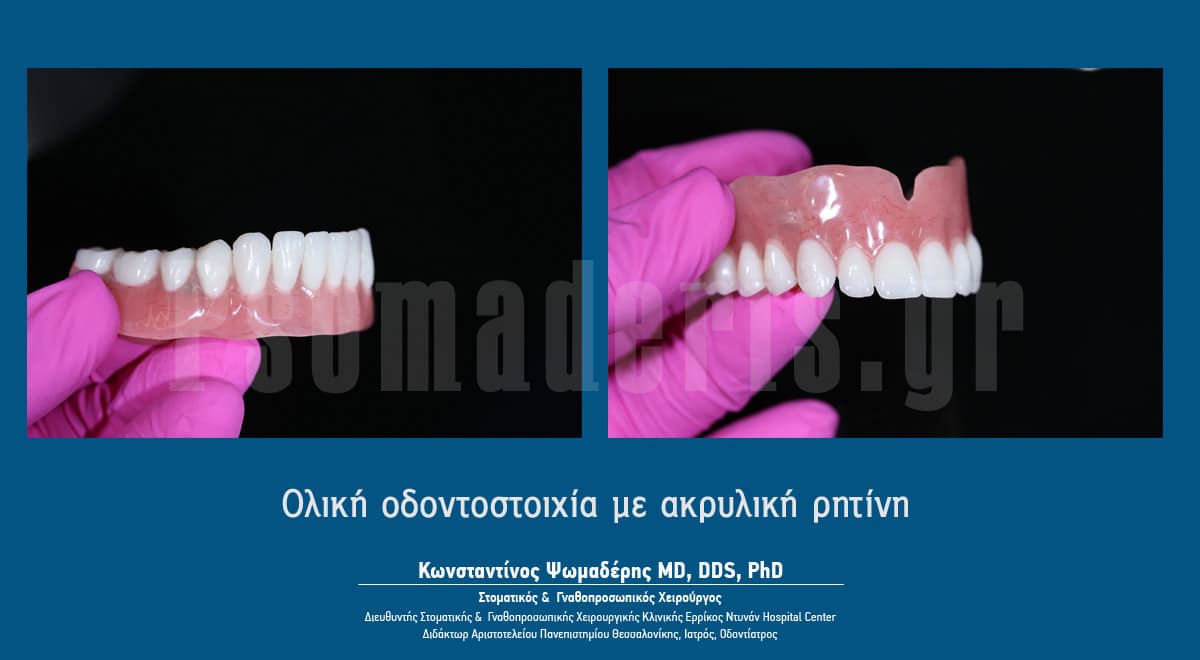 Δείτε Περιστατικά Εμφυτεύματα Δοντιών Πριν & Μετά