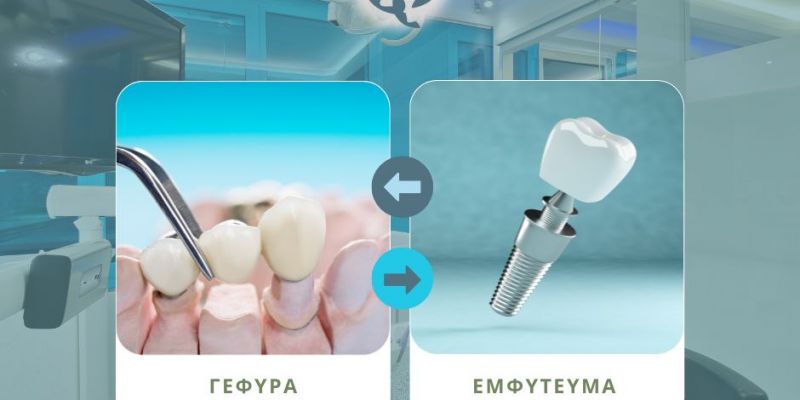 Εμφυτεύματα Δοντιών Τιμές - Κόστος - Γναθοχειρουργός Dr. Ψωμαδέρης ...